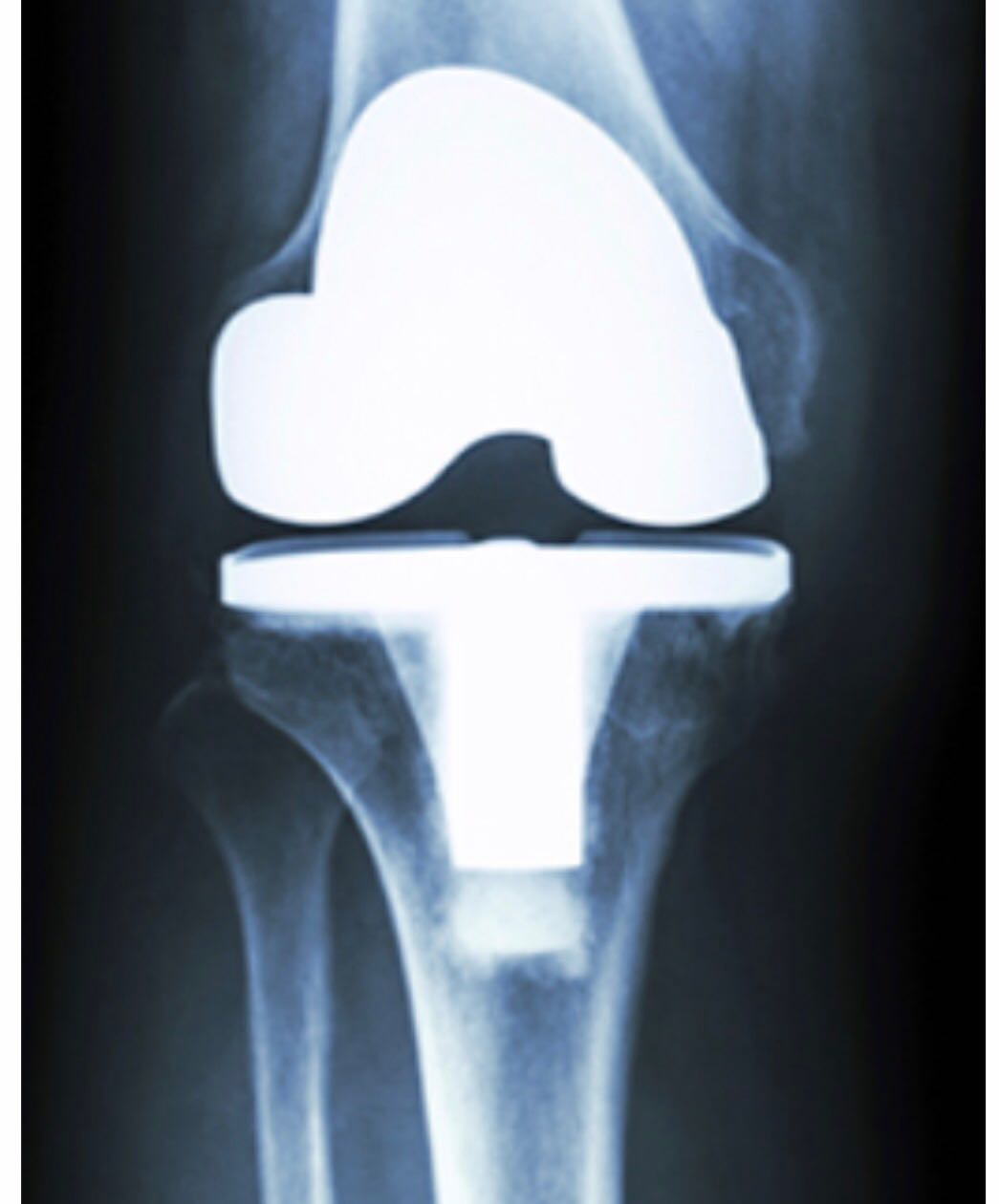 PRÓTESIS COMPLETA DE RODILLA - Praxia Body Repair