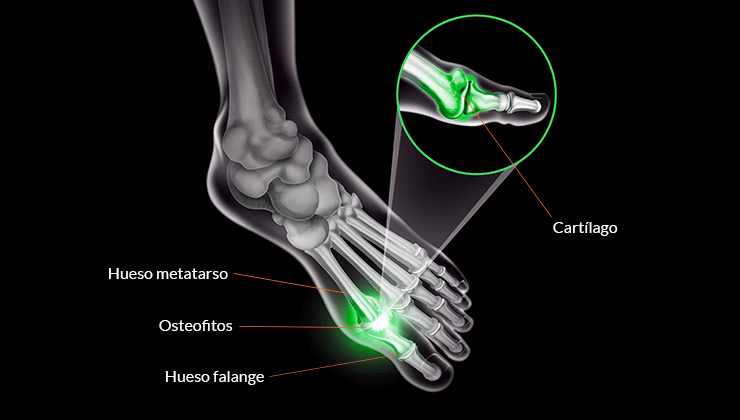 El Dedo Gordo del Pie: Hallux Rigidus - Praxia Body Repair El Dedo Gordo del Pie: Hallux Rigidus - Praxia Body Repair
